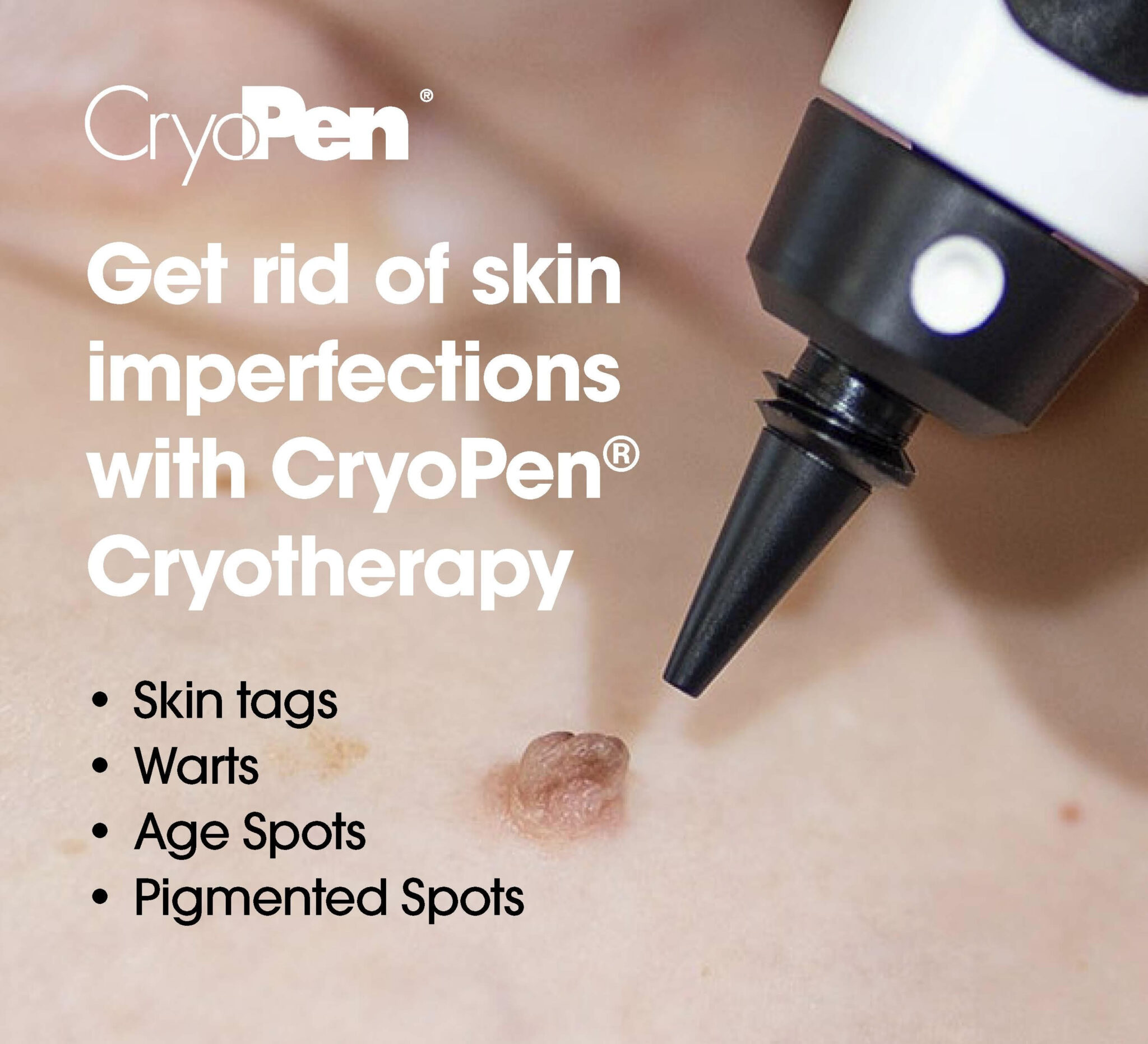 CryoPen Treatments | Leicester & The Midlands
