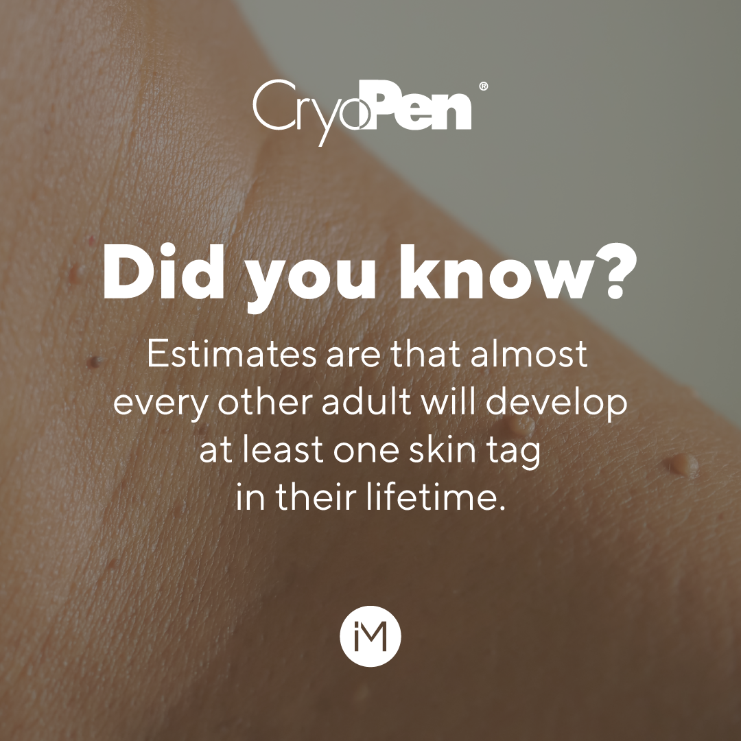 CryoPen Treatments In Leicester & Oxford | Book Cryogen Therapy